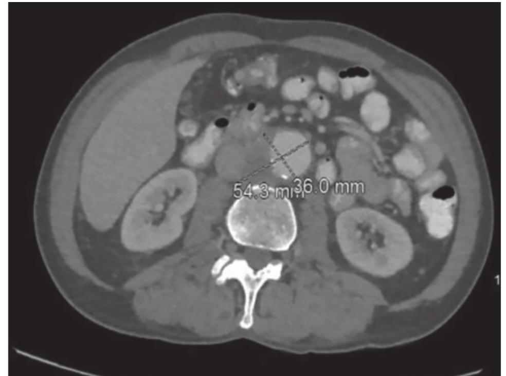 Ct angiogram of abdomen and pelvis with the trans- verse