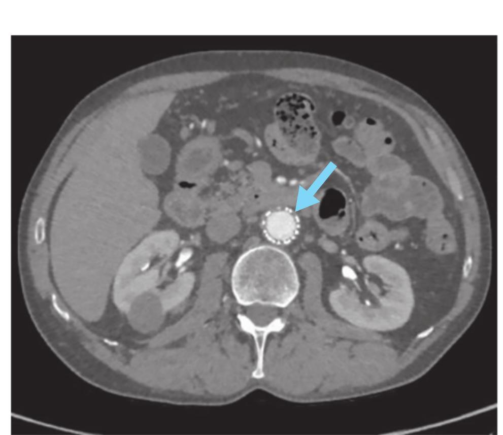 Transverse ct angiogram of abdomen and pelvis post-evar