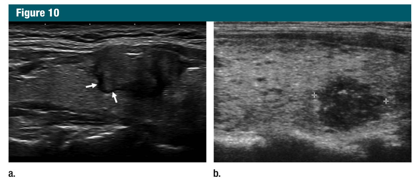 (a) sagittal image of a 2.2-cm carcinoma in a 61-year-old