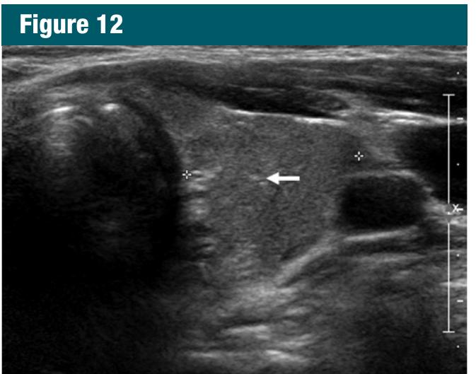 Sonogram of the left thyroid lobe in a 42-year-old man.