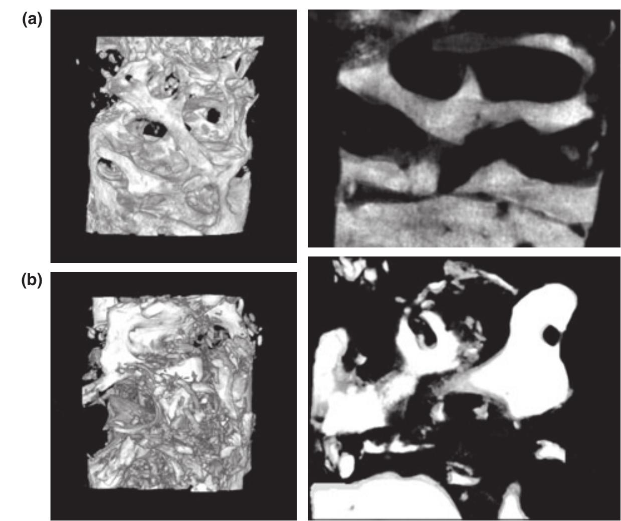 Maxillary bone. anterior (a) and posterior (b) maxillary
