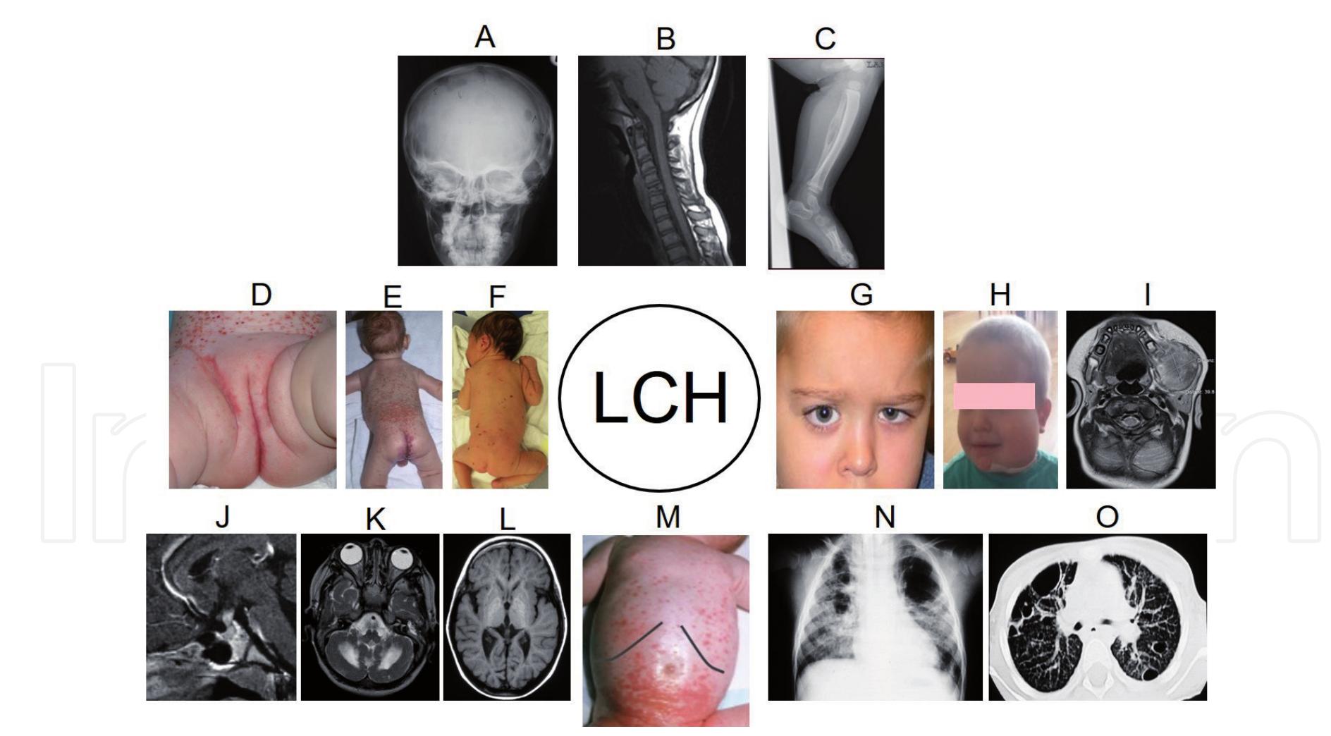 Spectrum of clinical manifestations. bone lesions in the
