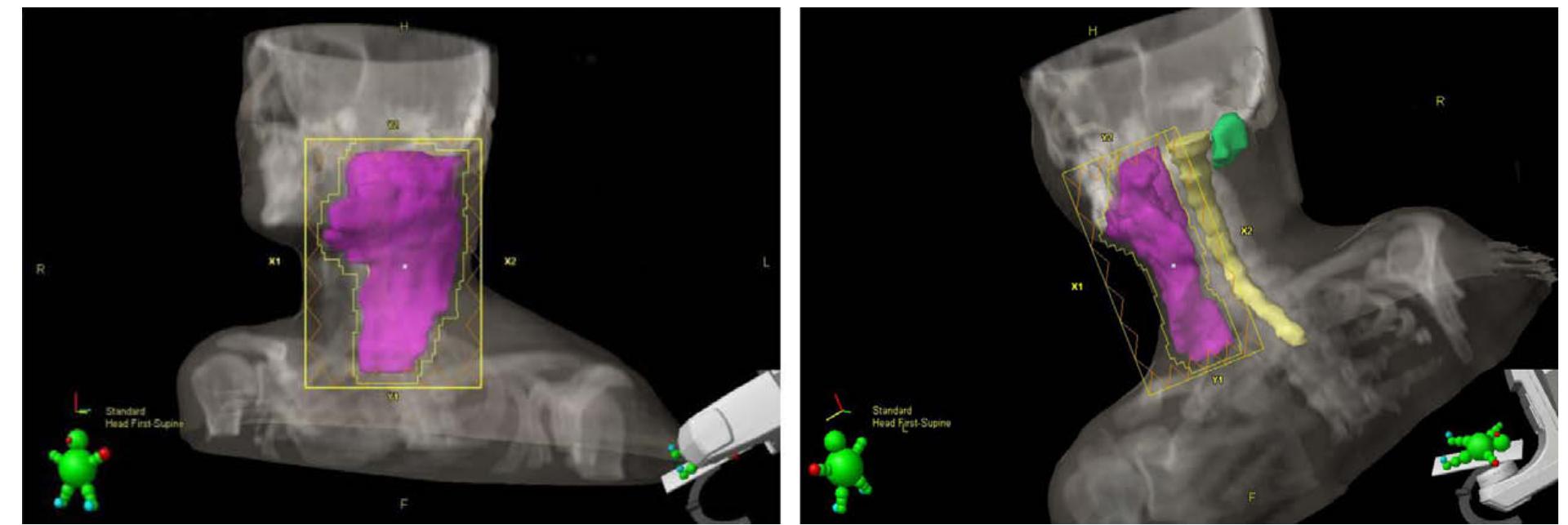 Typical two-field imrt beam arrangement with one