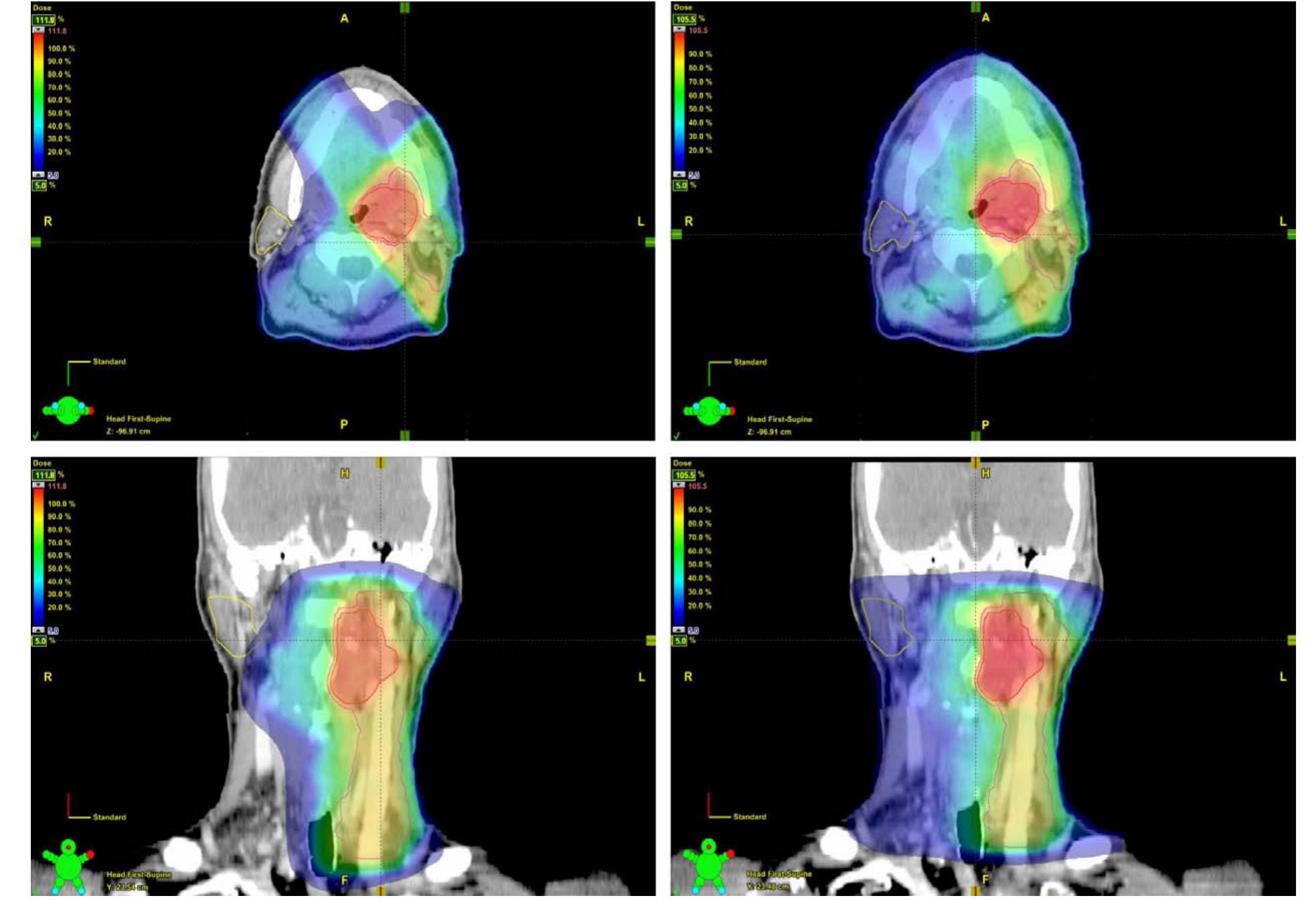 Two-field imrt (left) and seven-field imrt (right) color