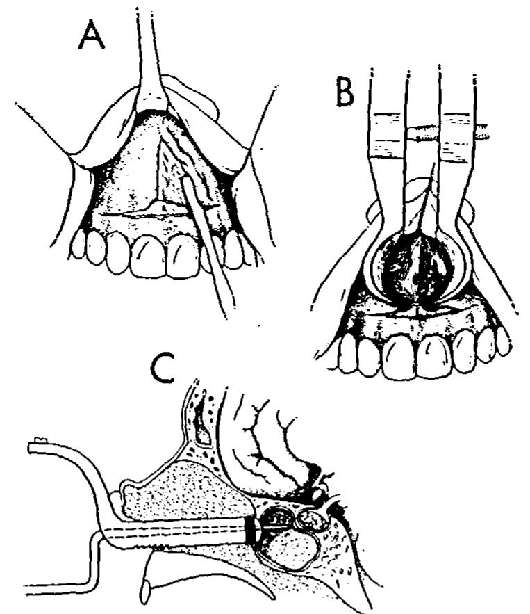 —steps in transsphenoidal technique of pituitary surgery. a,