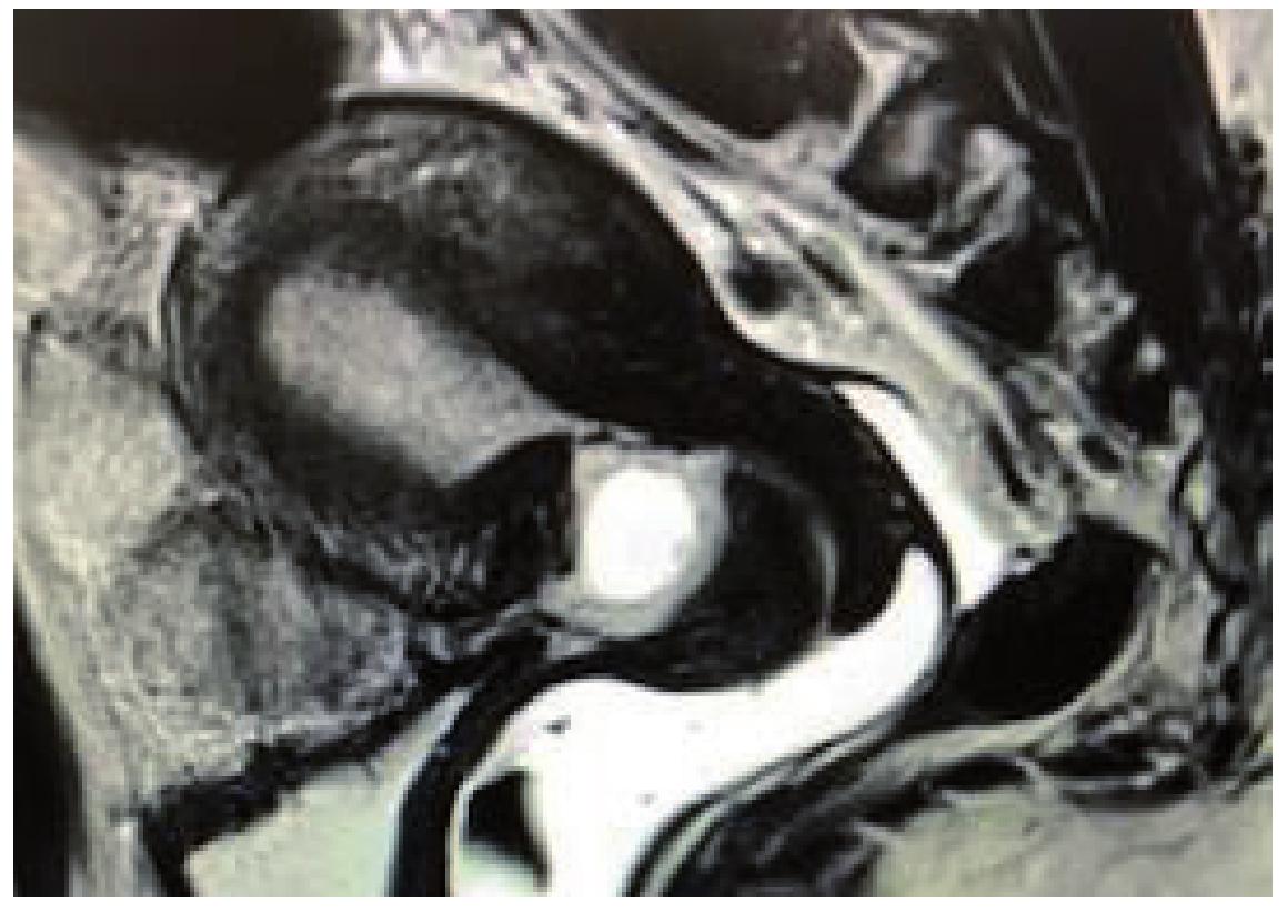 Mri of the uterus demonstrating an empty uterus, an empty