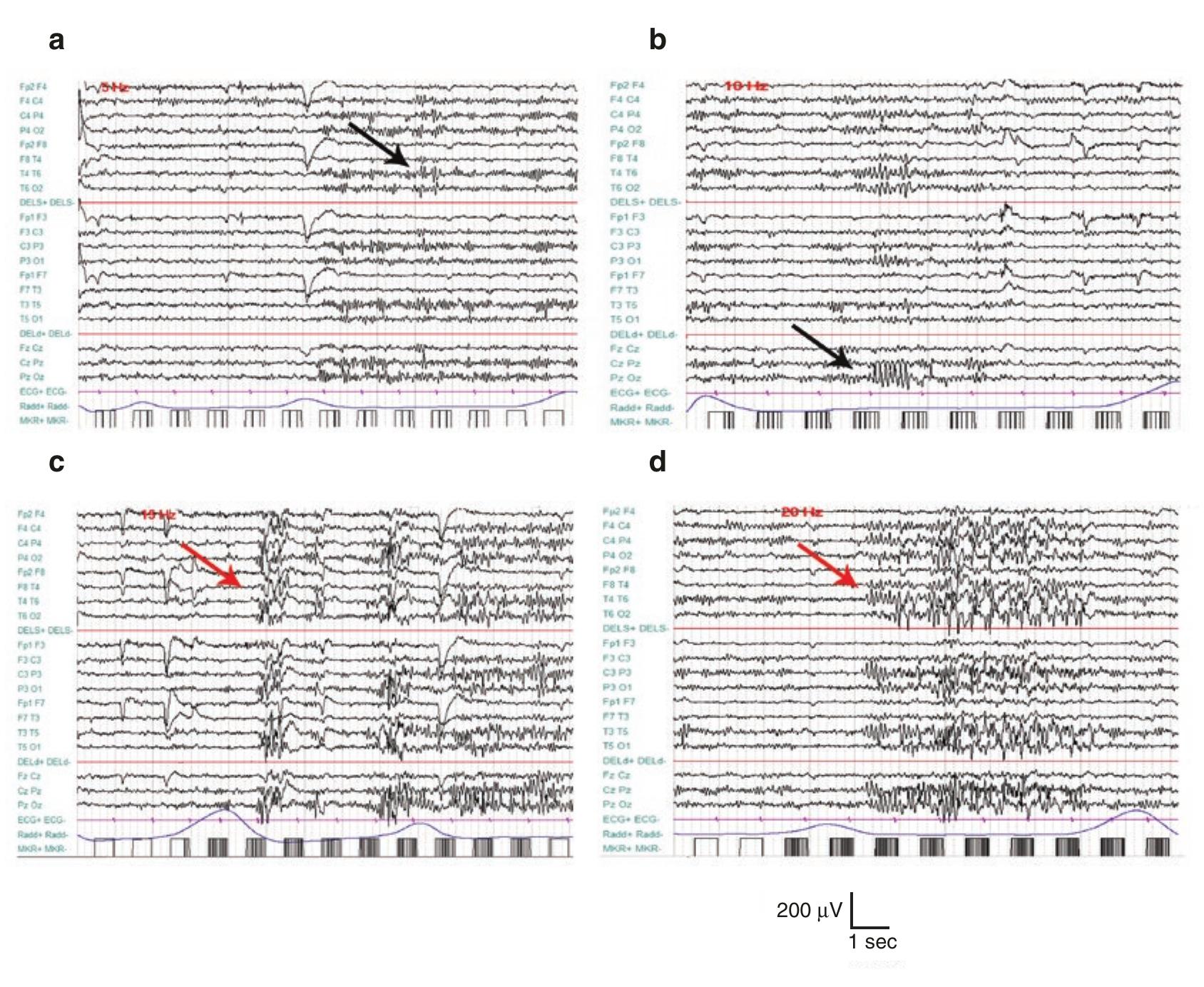 (PDF) How to Interpret Photoparoxysmal EEG Results