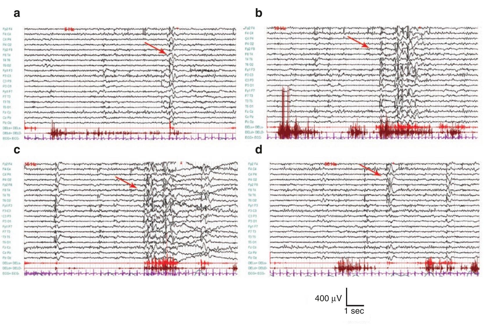 (PDF) How to Interpret Photoparoxysmal EEG Results