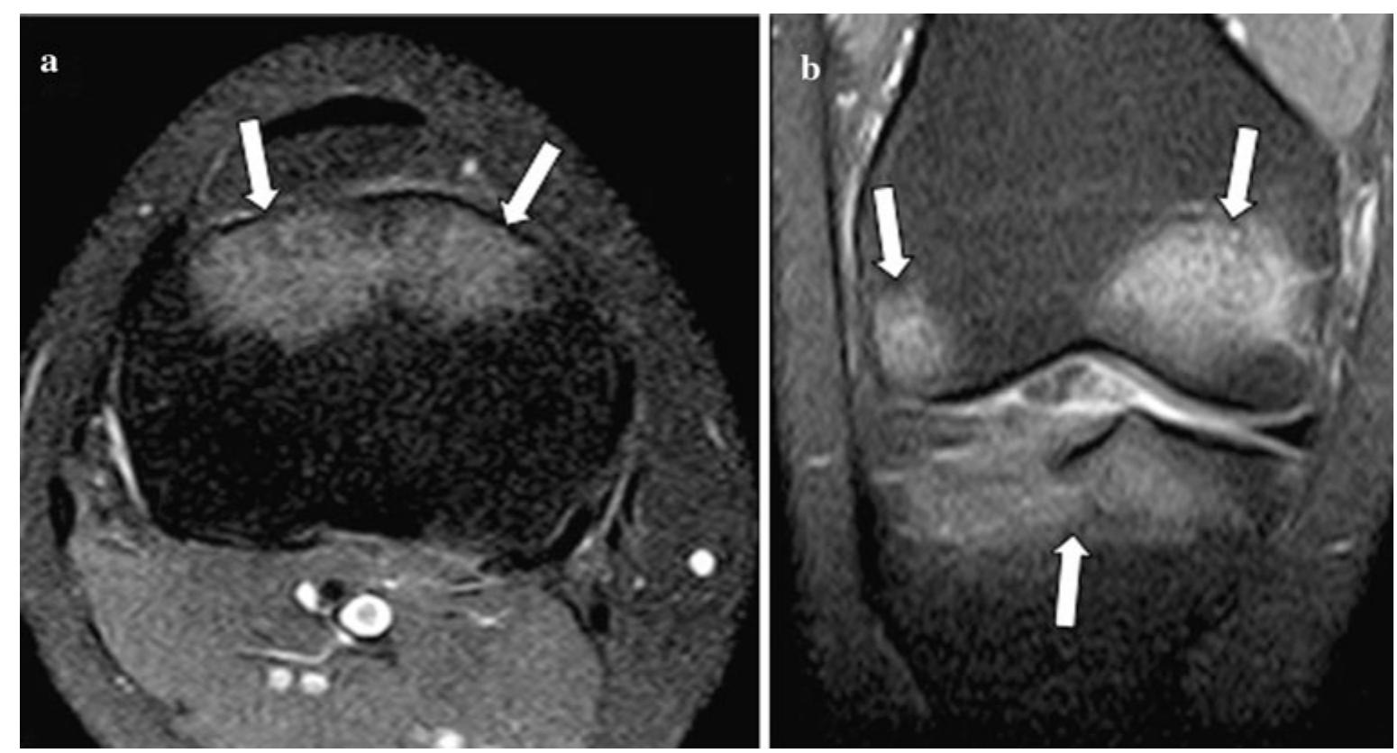 Pure hyperextension injury. a axial and b coronal pd fat sat