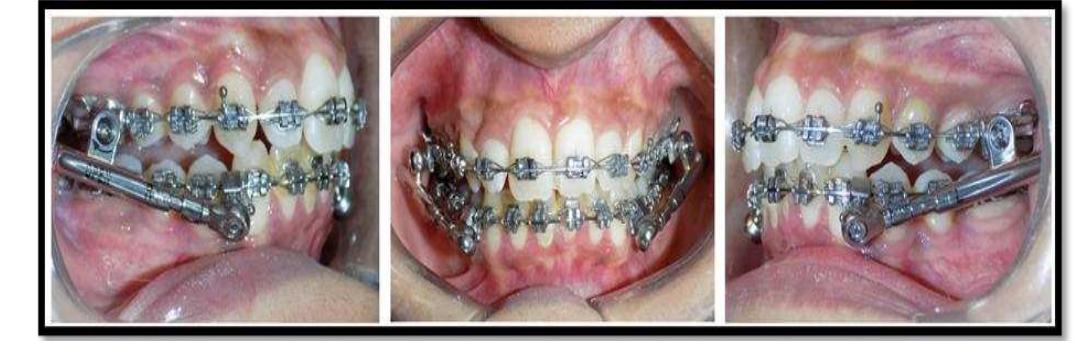 Powerscope insertion