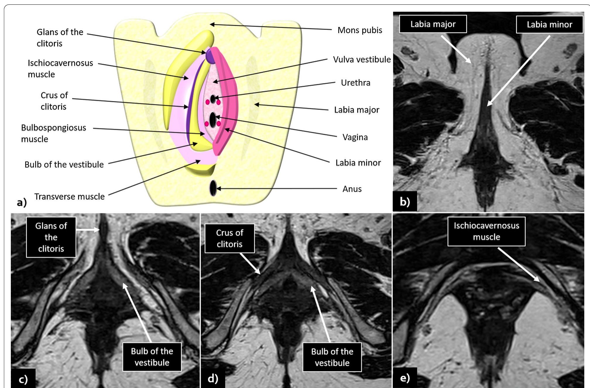 A schematic illustration of vulvar anatomy: b-e show mri