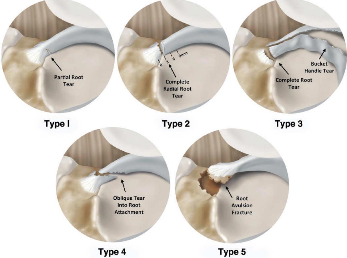 Meniscal root tear classification system illustrated in