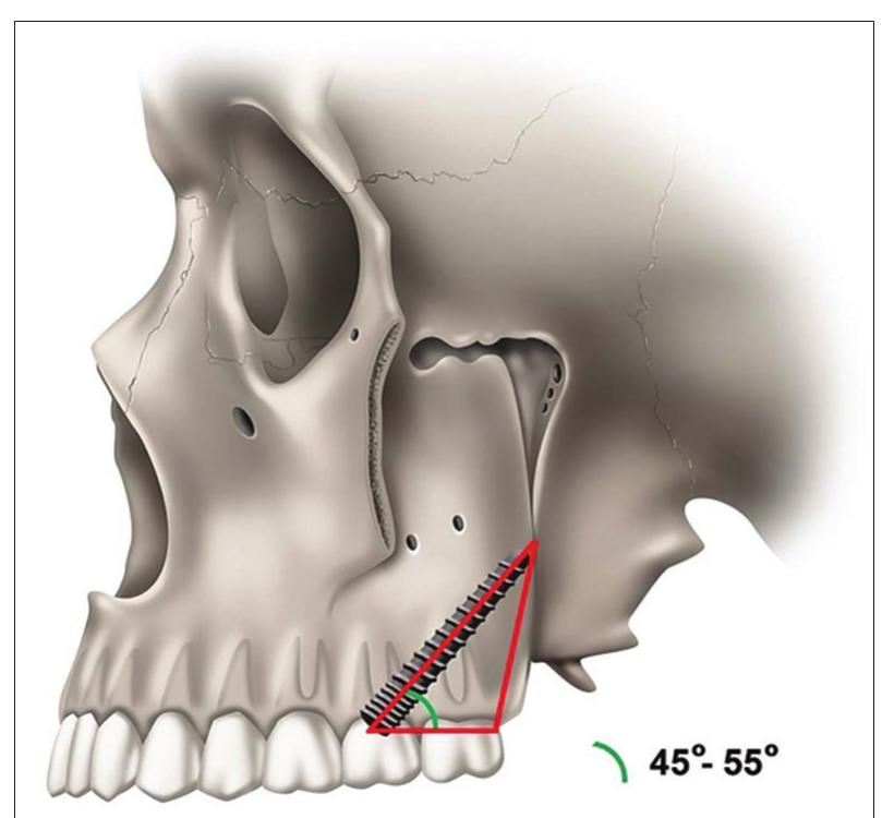 Pterygoid Process For Pterygoid Implant Placement And