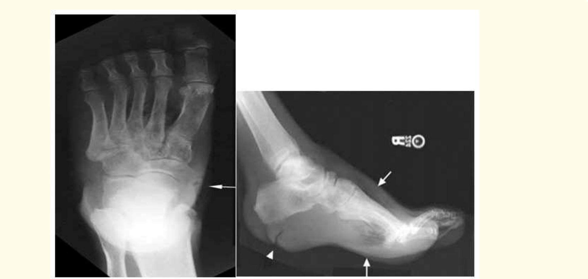 A: dosteomyelitis of the navicular bone on radiography. ap