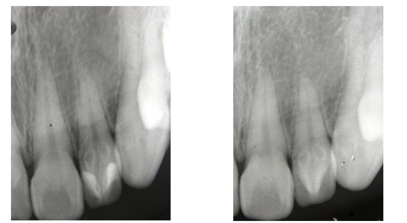 Periapical radiograph of the maxillary right lateral