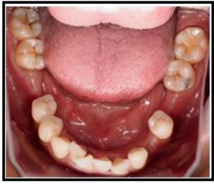 Intraoral figure tooth with a fixed prosthesis. the patient
