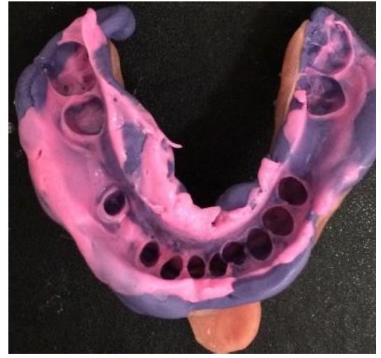 The impression of the abutment teeth gingival retraction was