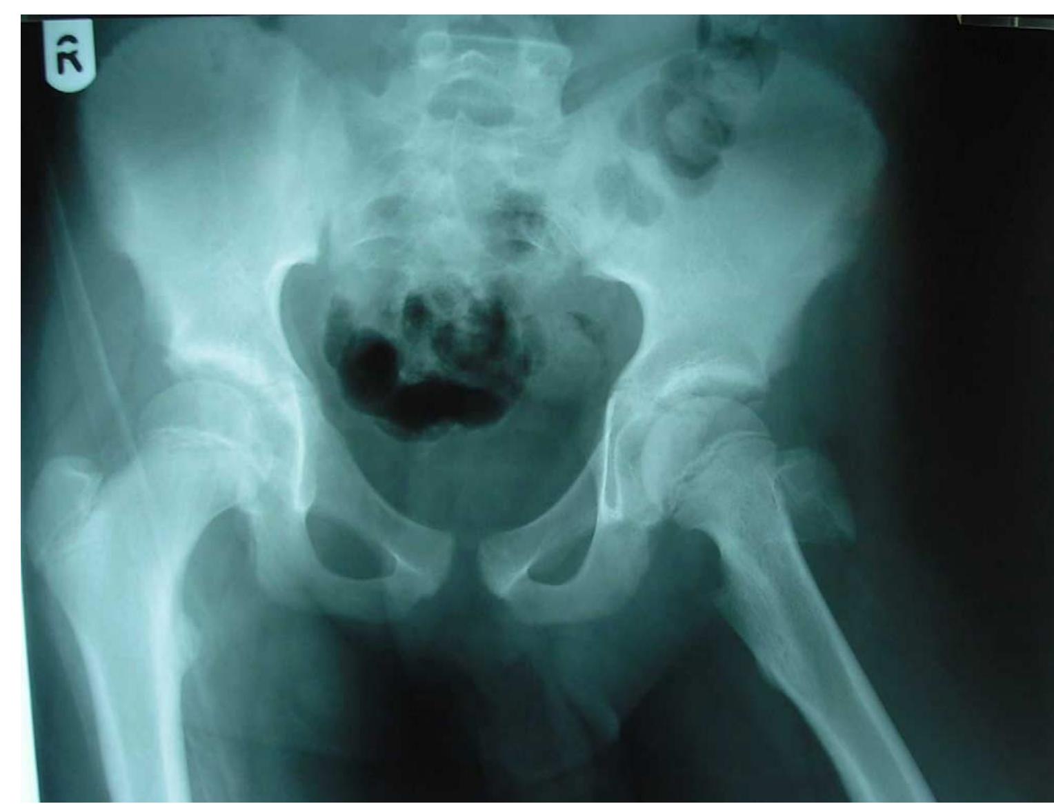 Figure 1 - from Avulsion fracture of the greater trochanter
