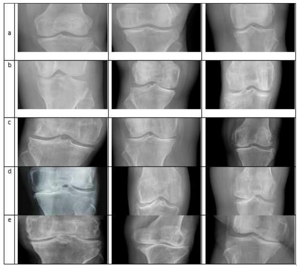 The knee osteoarthritis severity grading dataset, known as