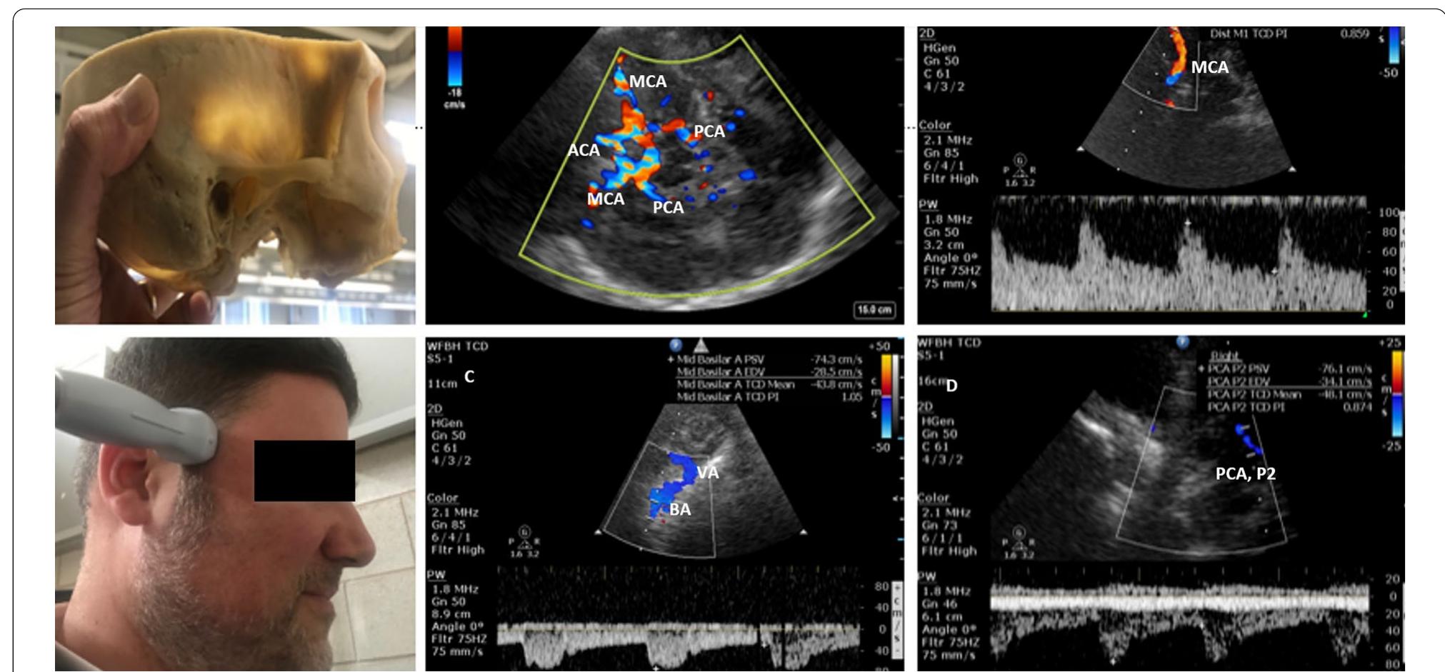 Brain ultrasound. a, b, d images obtained using phased-array