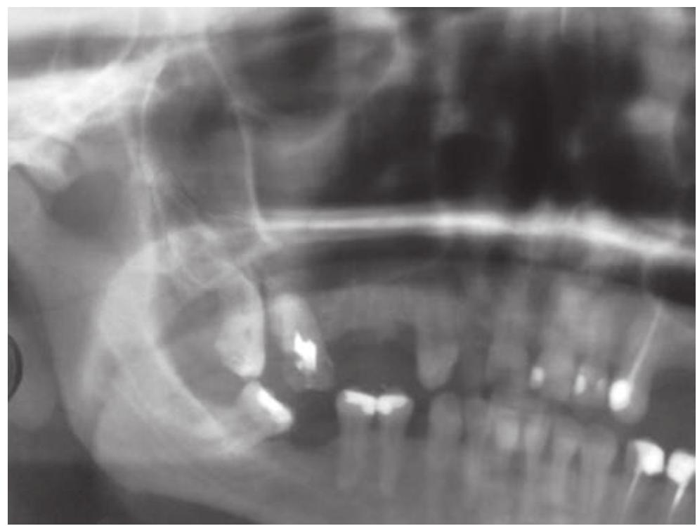 Orthopantomogram x-ray of the patient showing the fracture