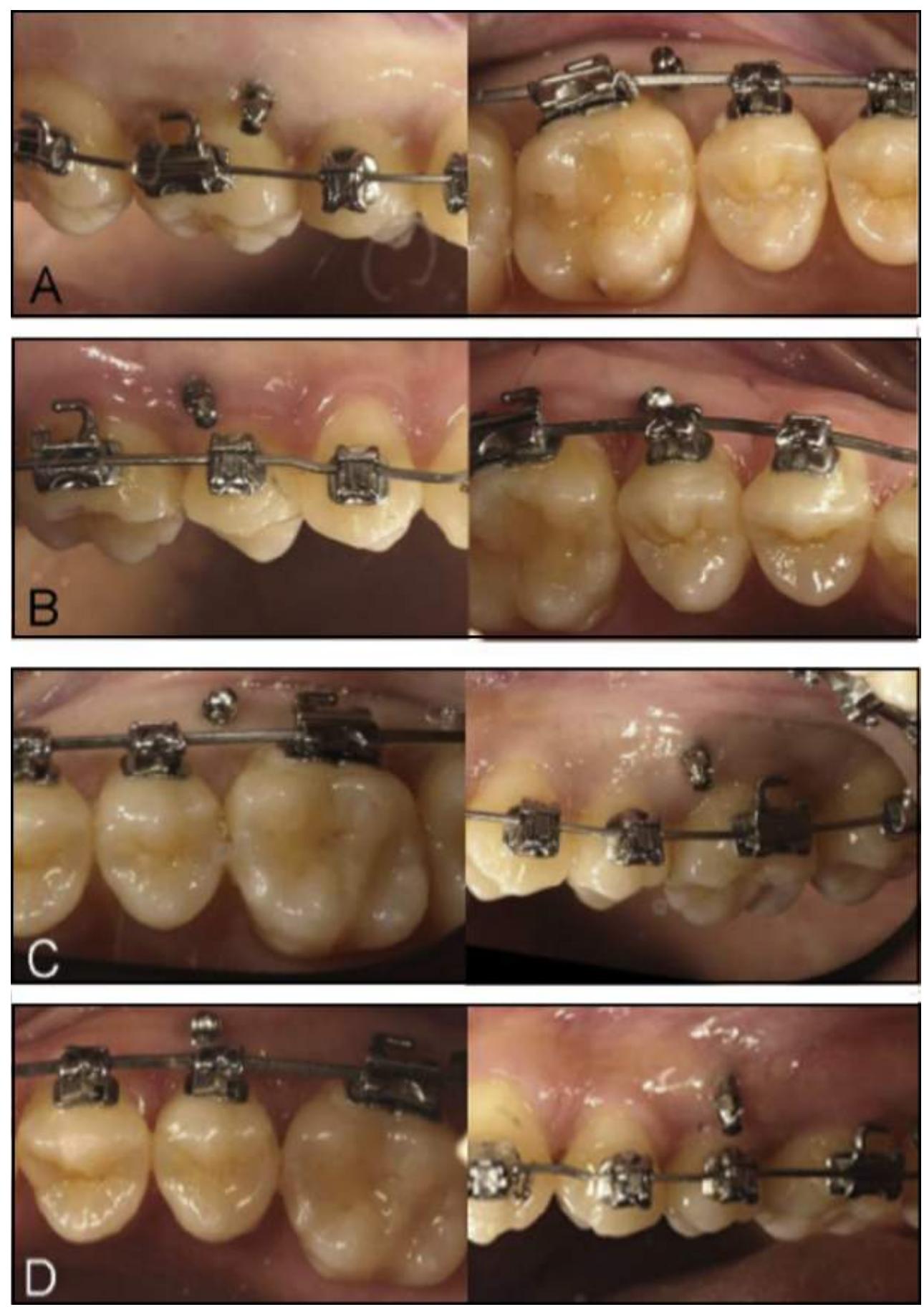 Aandc, distal movement of the maxillary molars: miniscrews