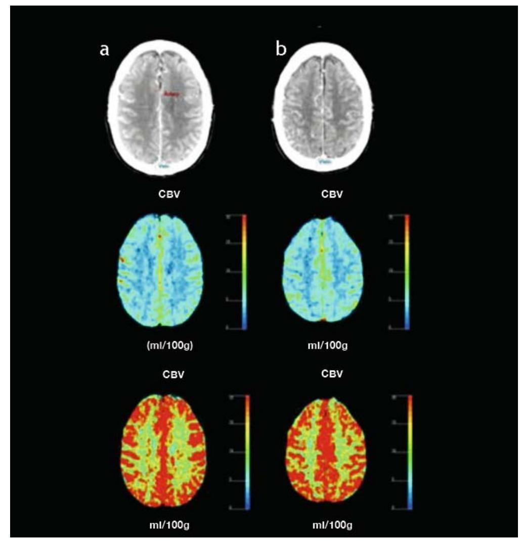 Influence of venous reference on cerebral blood volume (cbv)