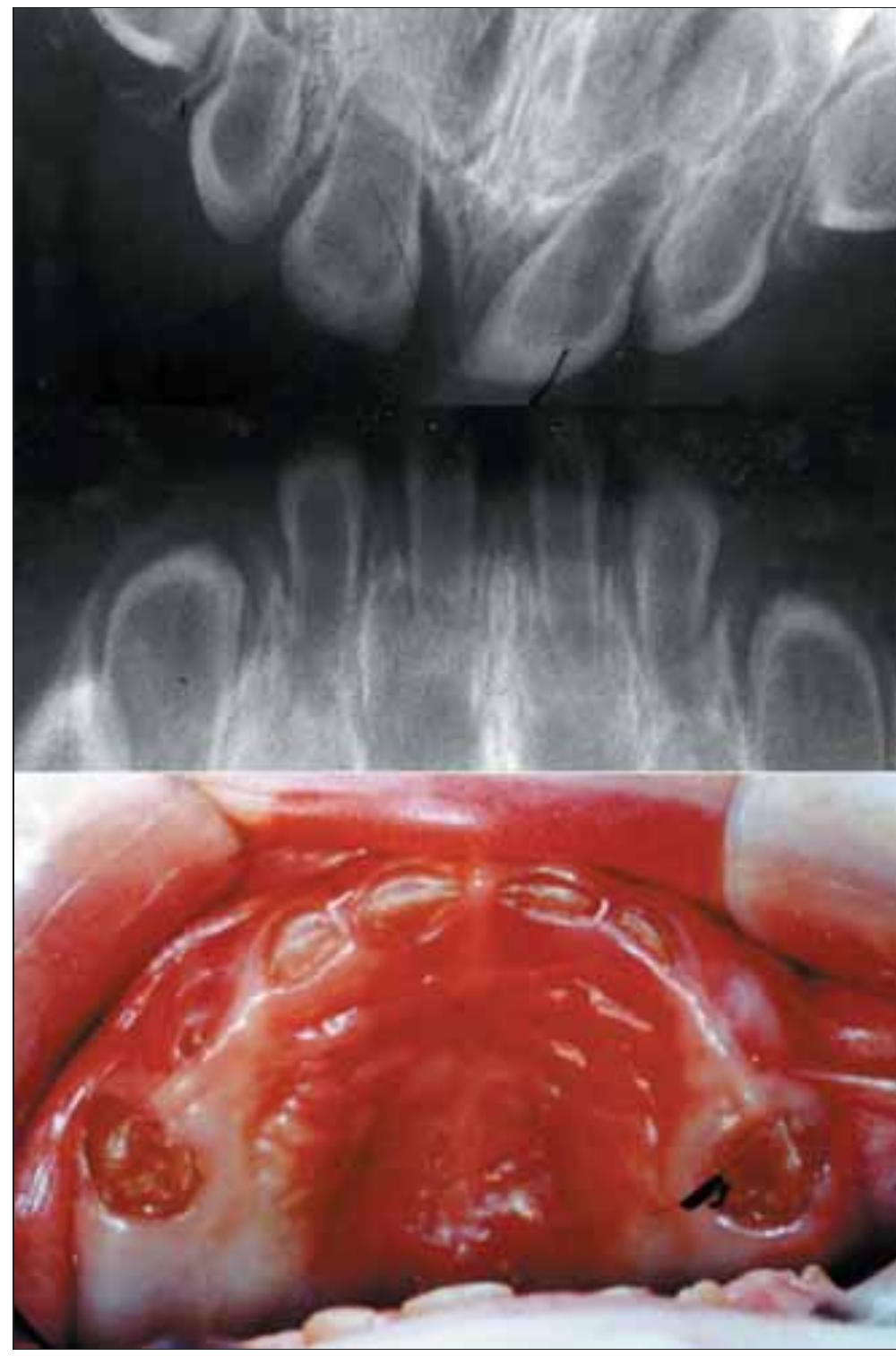 Periapical radiographs of upper and lower incisors of ml at