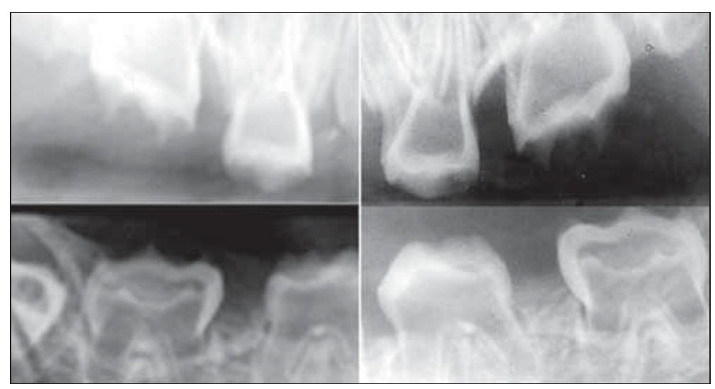 Periapical radiographs of posterior quandrants,