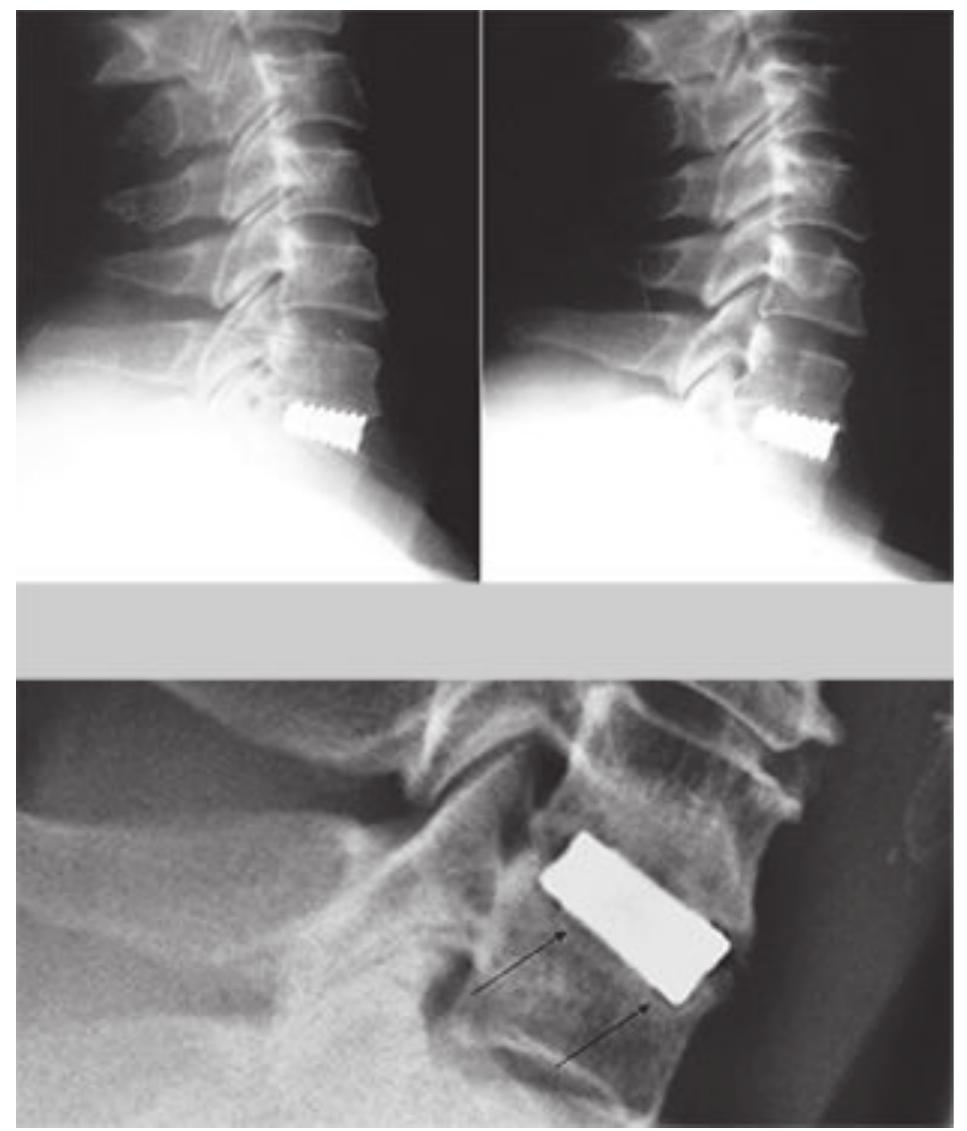 -4: (a) postoperative lateral radiograph of a patient with