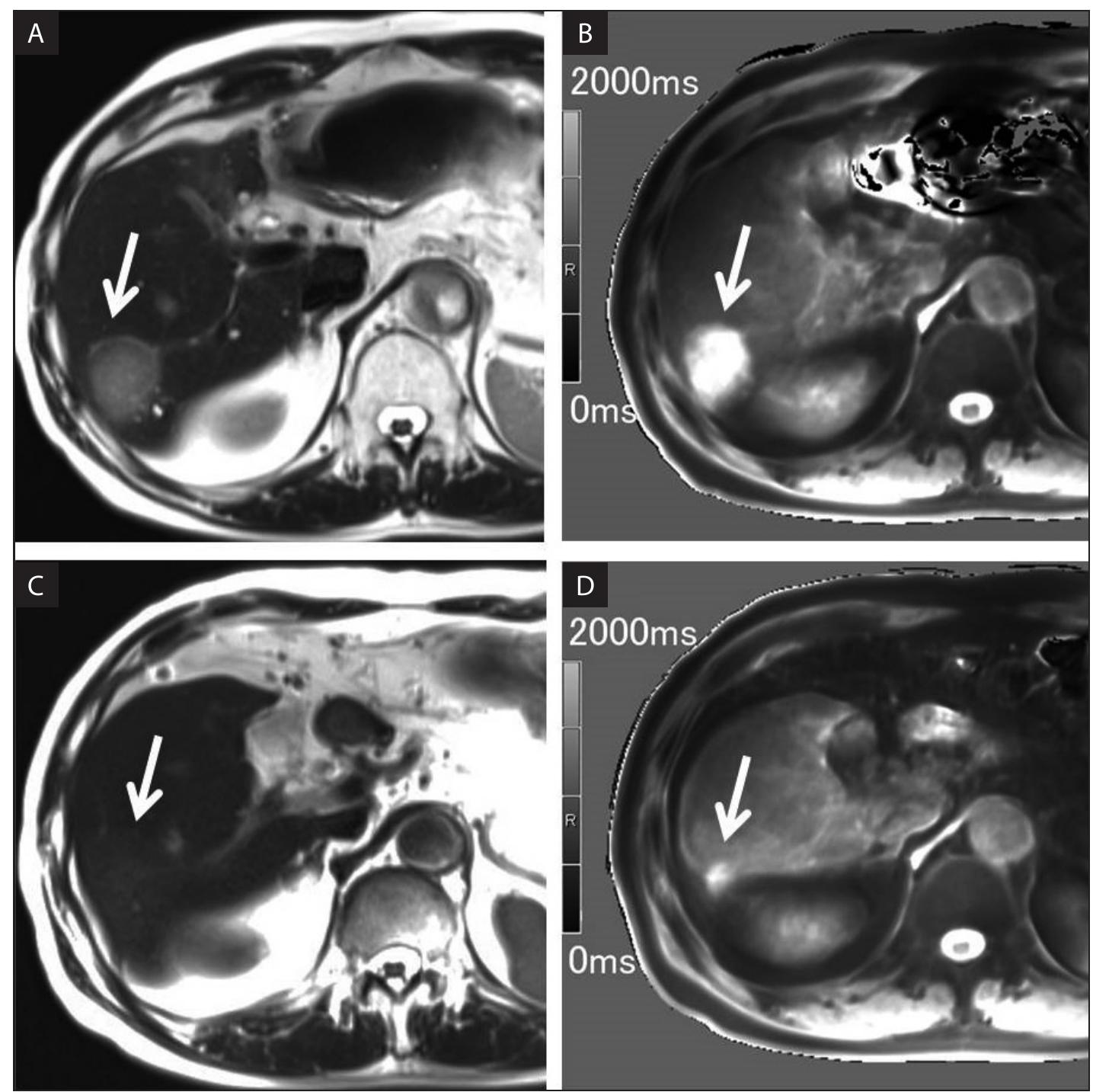 Multiparametric mri at 3t before and 3 months after
