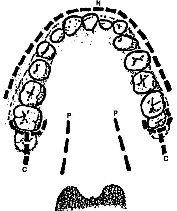 Vestibular and palatal incisions. h = buccal incision c