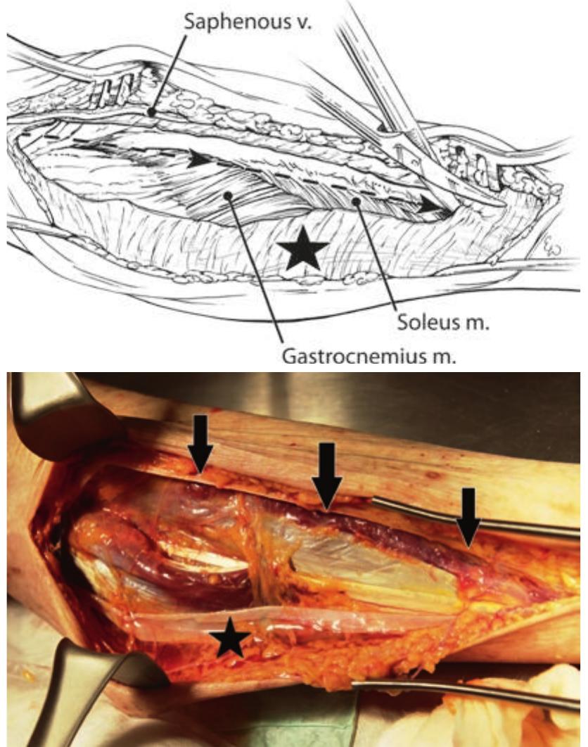 9 the medial incision as seen on the left lower leg is