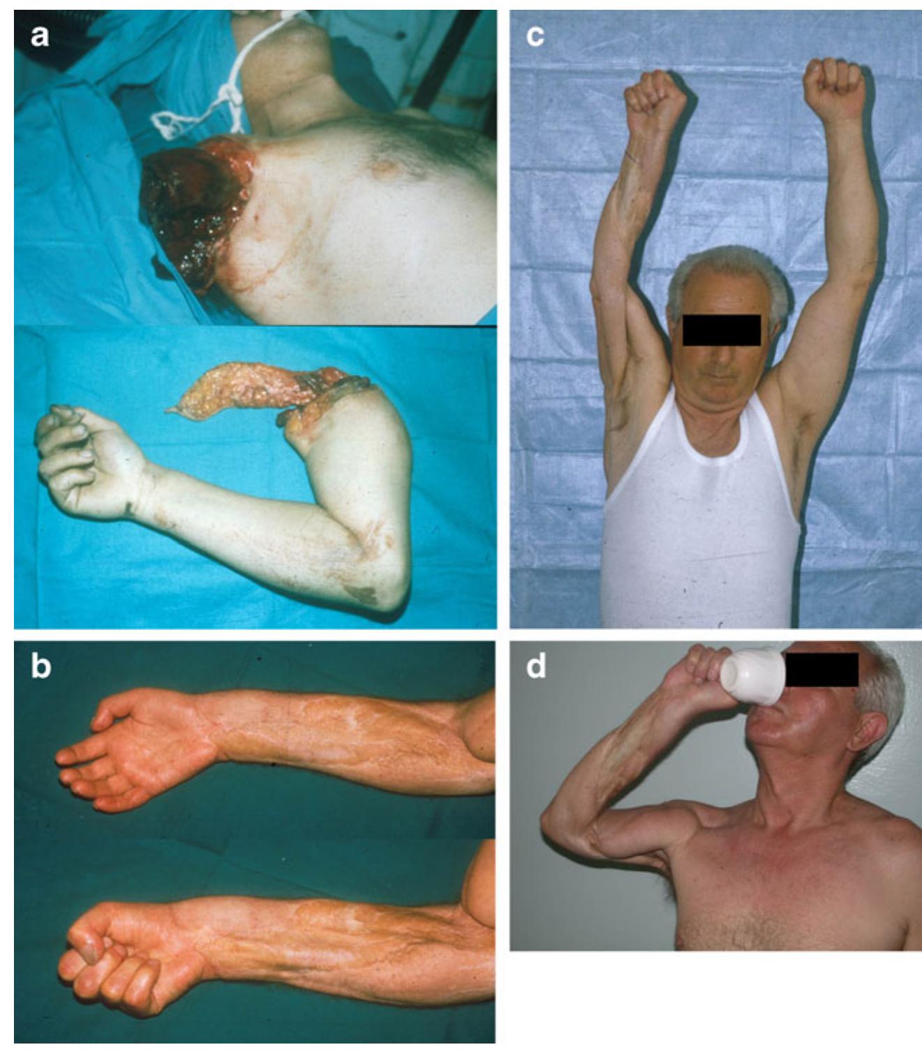Figure 1 - Current management of the mangled upper extremity