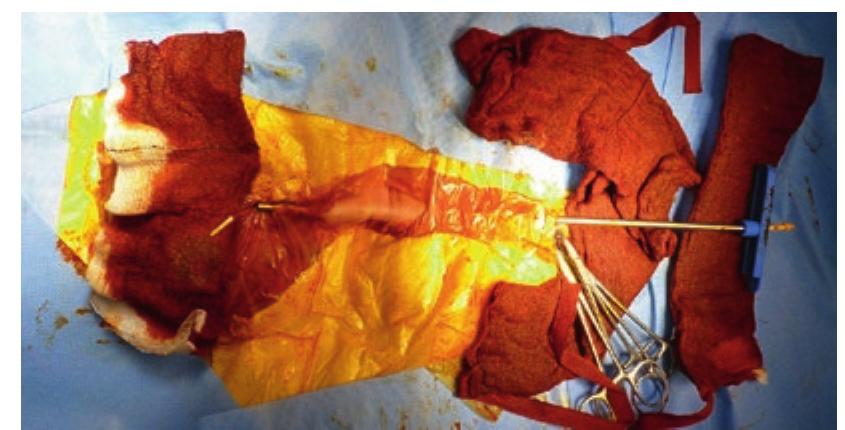 18 intraoperative image during insertion of ven-