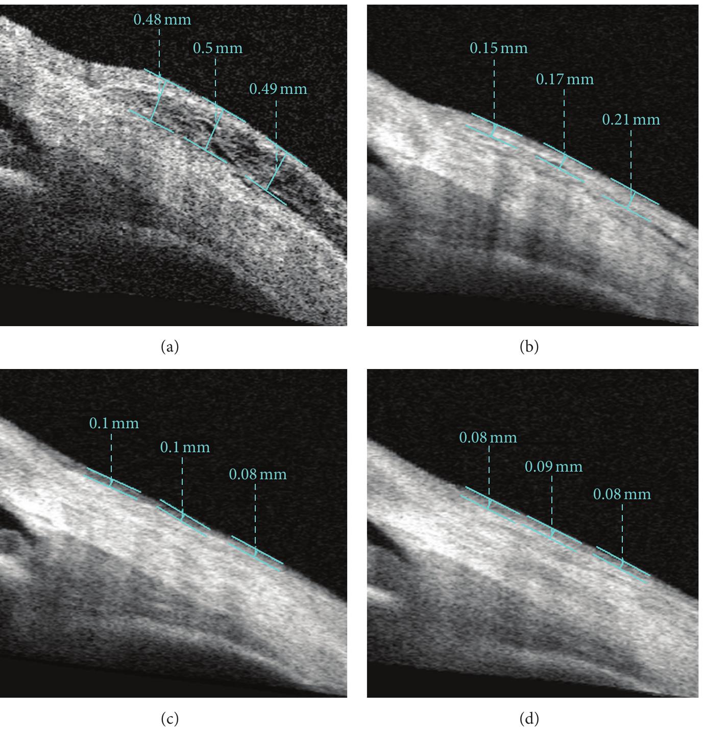 Ficure 4: imaging of as-oct shows measurement of thickness