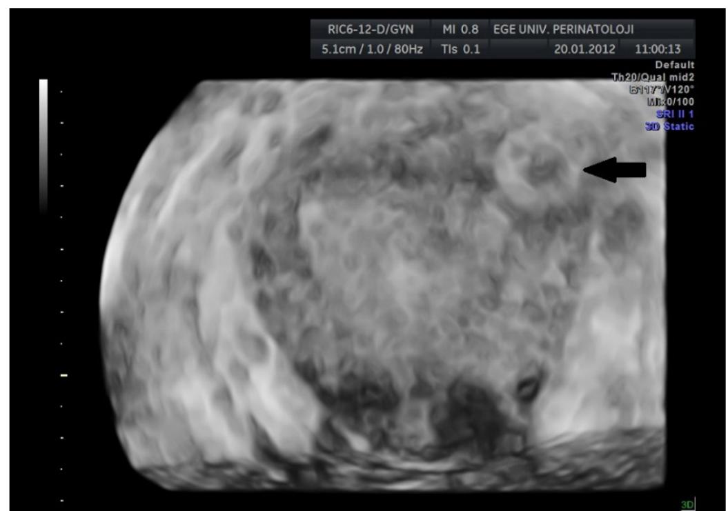 Transvaginal ultrasound image of the cervical pregnancy