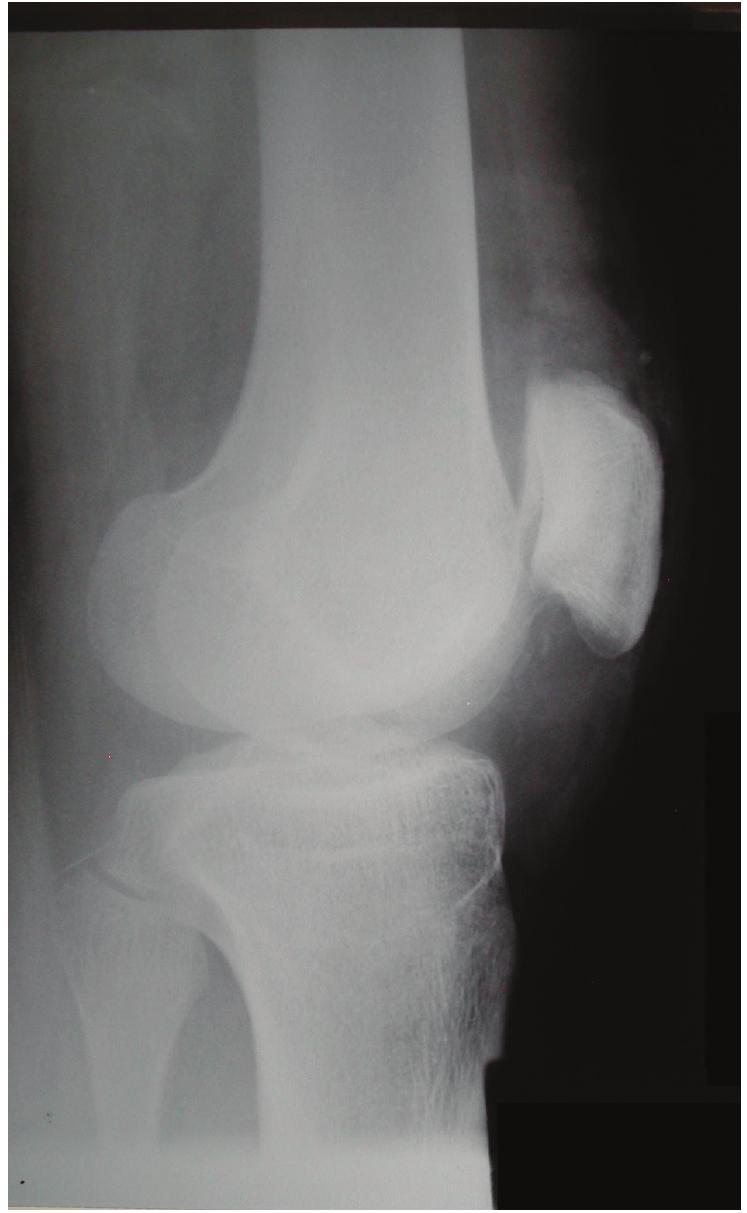 Lateral radiograph demonstrated the fracture by the