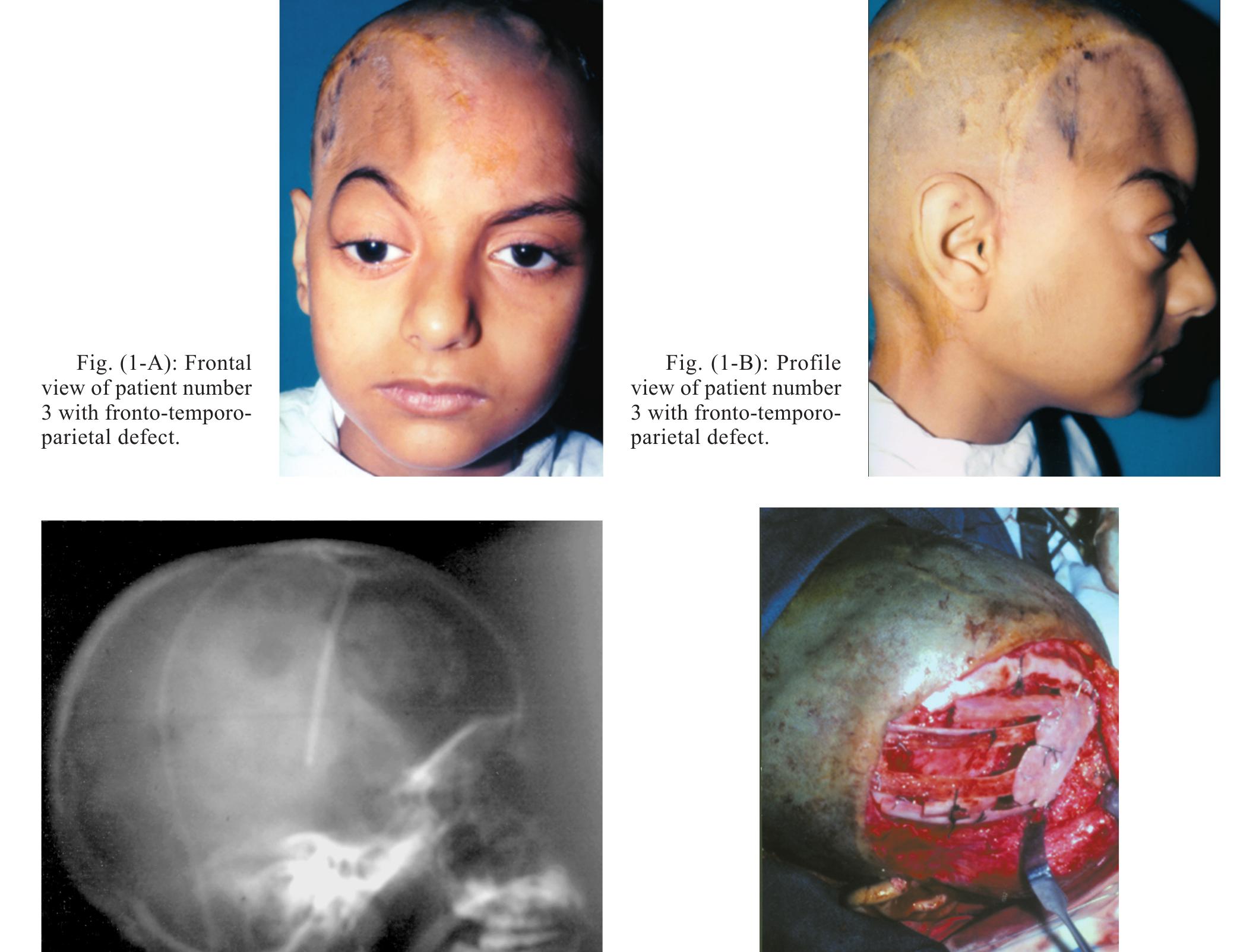 (1-c): lateral skull x-ray showing the defect. fig. (1-d):