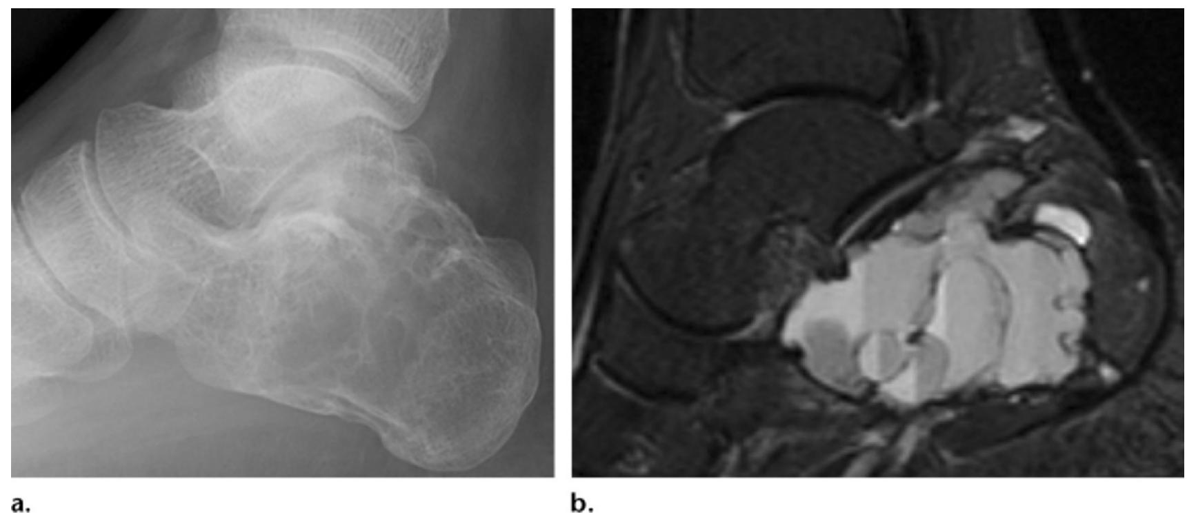 Gct of the calcaneus. (a) lateral radiograph shows a bubbly