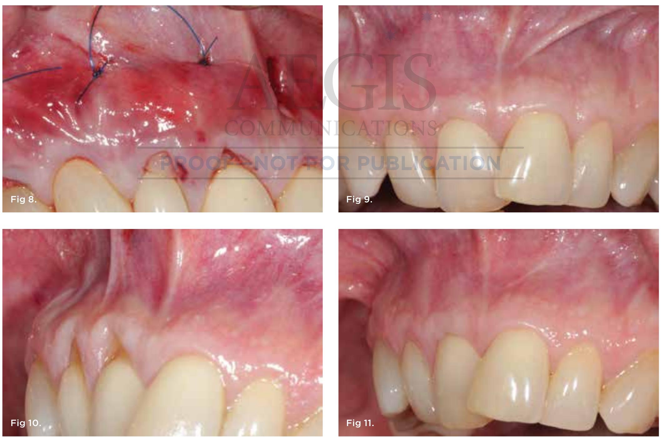 Apical periosteal suture below the mucogingival junction