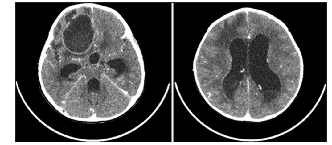 First head ct scan: abscess cavity in the right frontal
