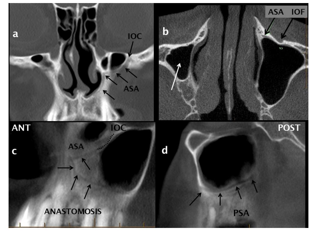 = the anterior superior alveolar neurovascular canal and
