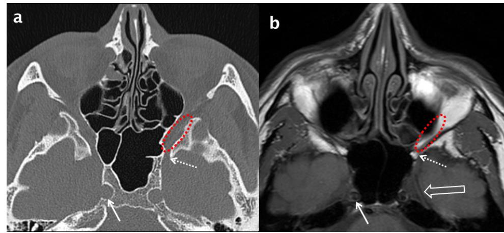 = normal axial anatomy at the superior margin of the maxil-