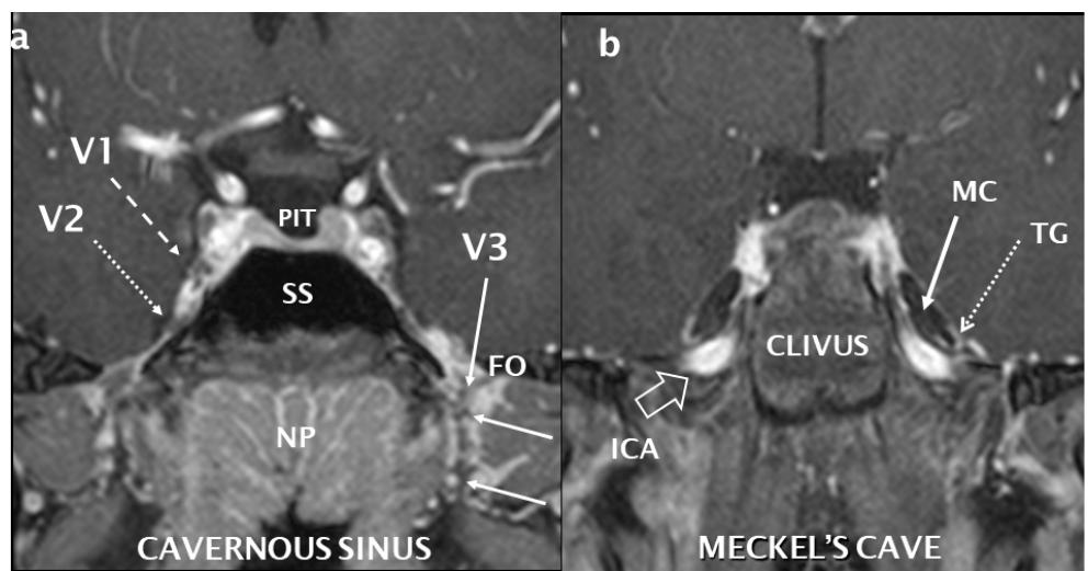 Figure 18 - The maxillary sinus: physiology, development and
