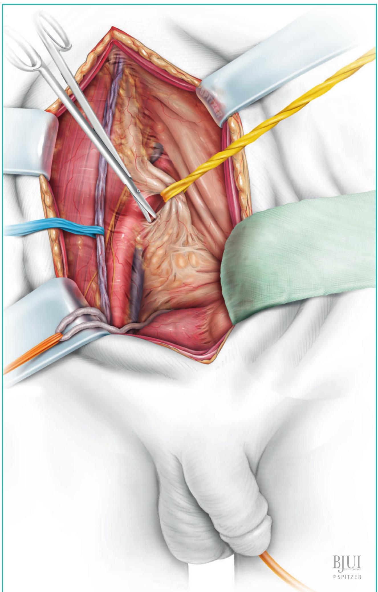 Figure 2 - Psoas hitch and Boari flap ureteroneocystostomy