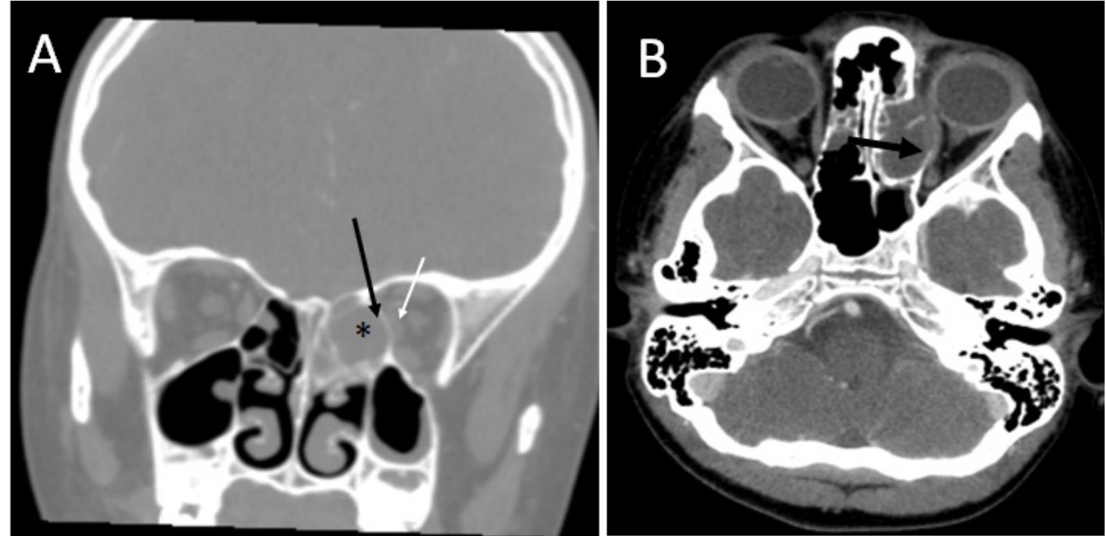 Pre-operative coronal (a) and axial (b) ct scan. a soft