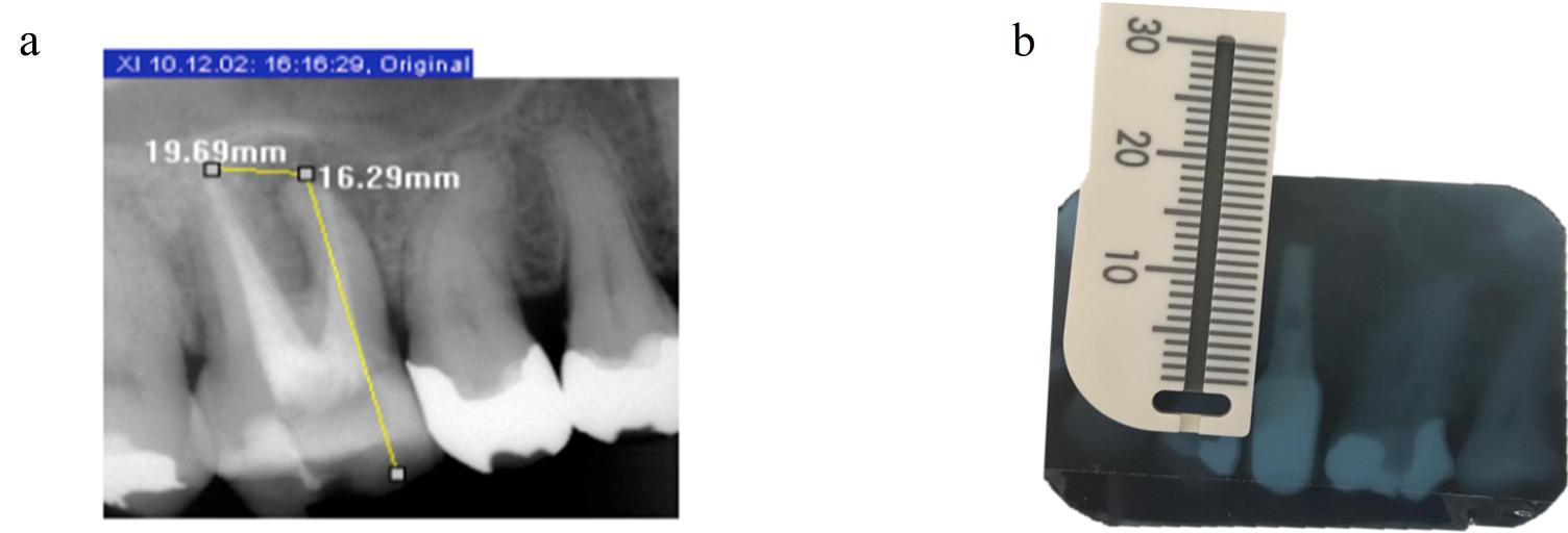 Measurement of bone level in radiographs was done by