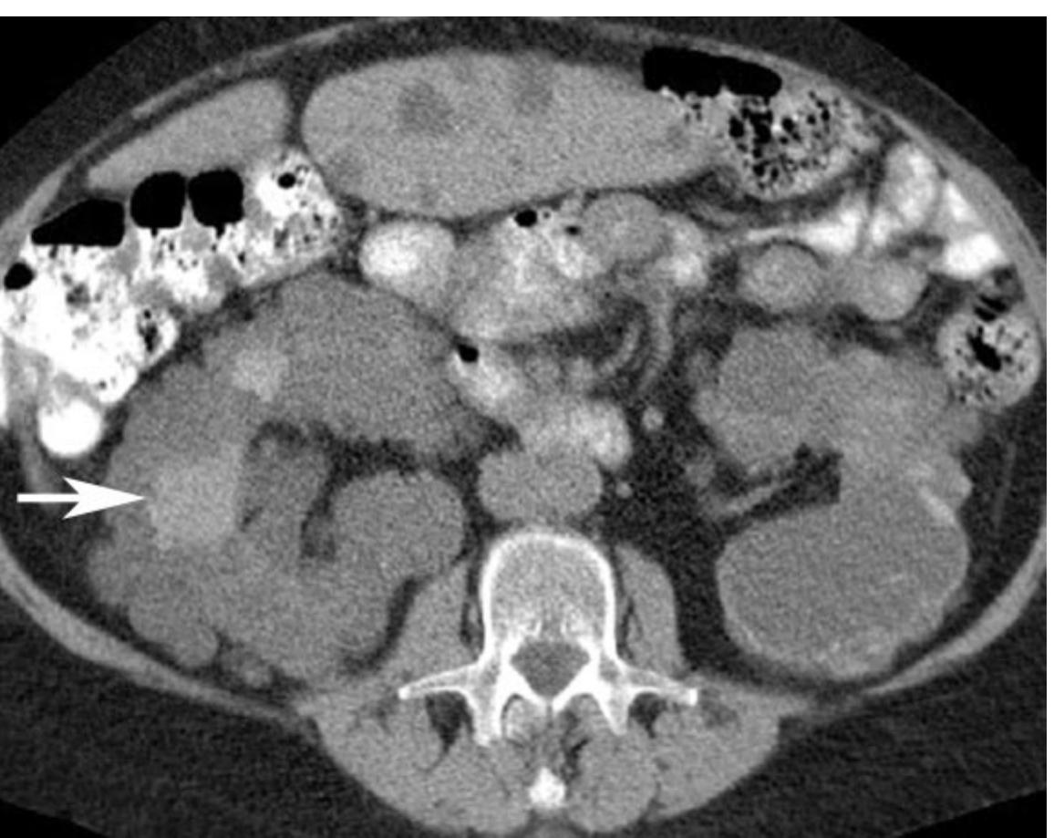 Multilocular cystic renal cell carcinoma in a 52-year-old