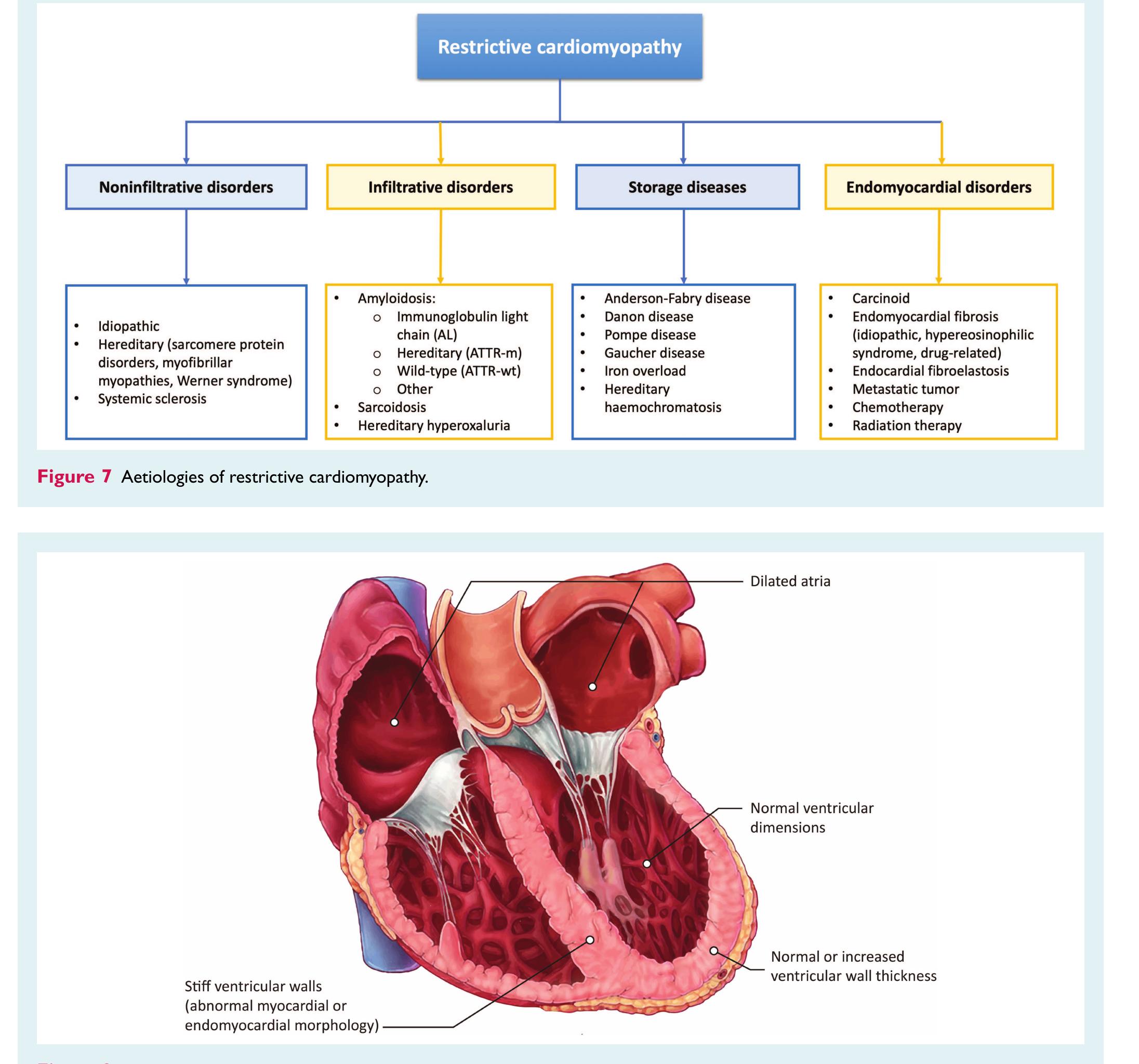 Figure 9 - Heart failure in cardiomyopathies: a position